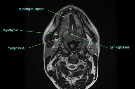 Genioglossus Mri Epos™