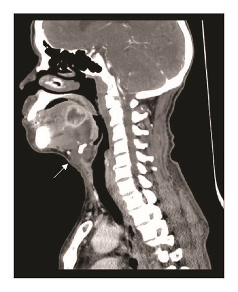 Contrast Enhanced Ct Scan Demonstrated An Abscess At Left Posterior