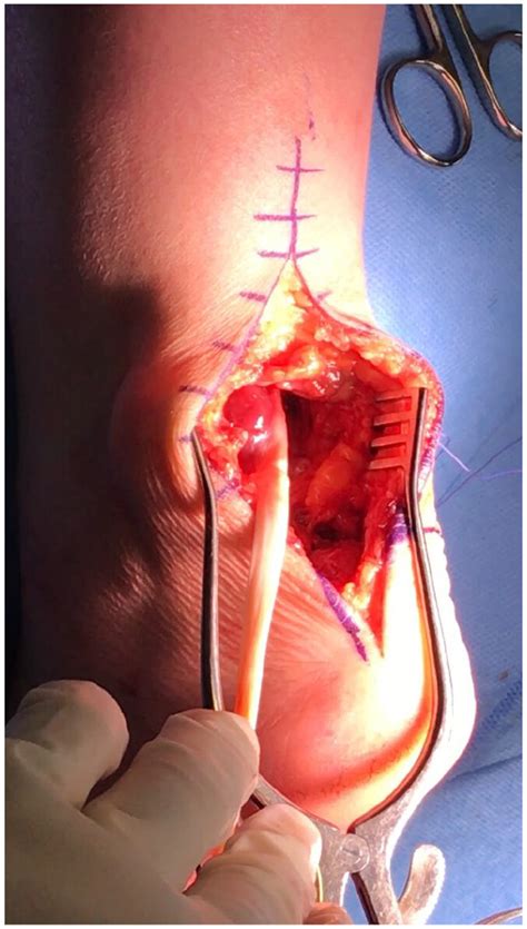 Does Fhl Tendon Transfer Alter The Outcome Of Haglund Deformity