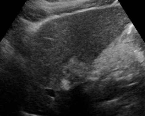 Liver Atlas Diagnosis Cholangiocarcinoma