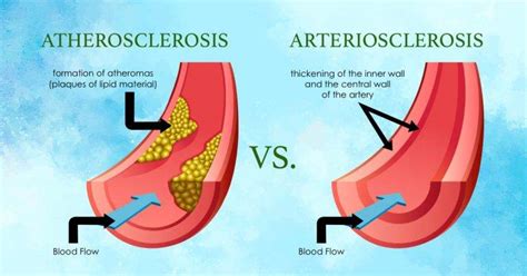 Arteriosclerosis
