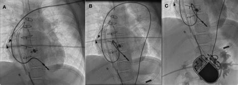 Combined Epicardial And Endocardial Pacing When Epicardial Ventricular Download Scientific