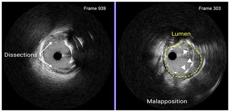 Case 3 Intraluminal Filling Defect In The Proximal Lm Cardiology Apps