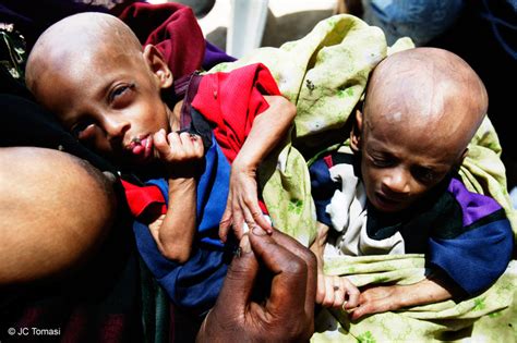 La Desnutricion Infantil