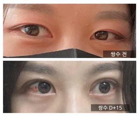 [쌍수 후기 1] 절개 눈매교정 윗트임 관리 꿀팁 L 수술직후~d 15 네이버 블로그