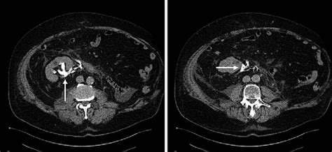 Contrast Enhanced Ct Urography Phase A Extravasation Of The Contrast