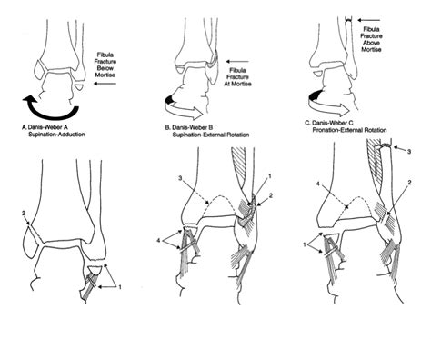 External Rotation Of Ankle