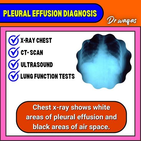 Pleural Effusion Diagnosis Pleuraleffusion Pleuraleffusion Pleuraleffusiondiagnosis