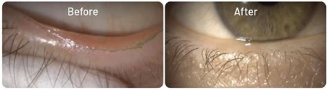 Crstoday Effectively Treating Demodex Blepharitis