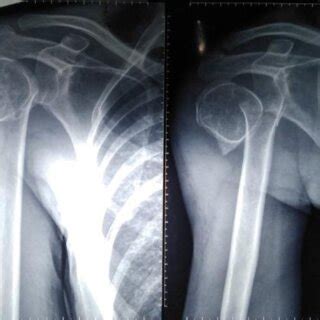 Proximal Humerus Fracture Download Scientific Diagram