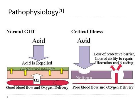 Ppt Gi Prophylaxis Powerpoint Presentation Free Download Id 6878649