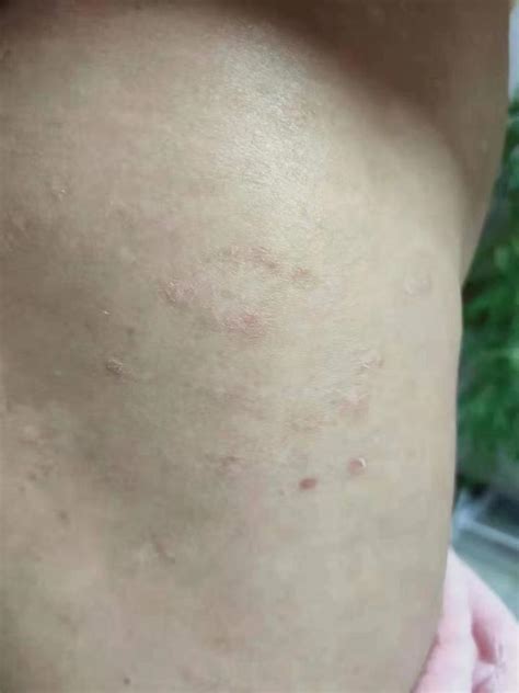 荨麻疹为啥只有深夜起？ 知乎