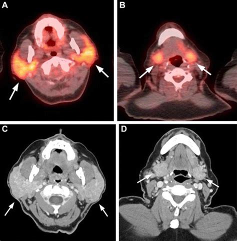 Anatomic And Functional Imaging Of Immunoglobulin G4related Disease