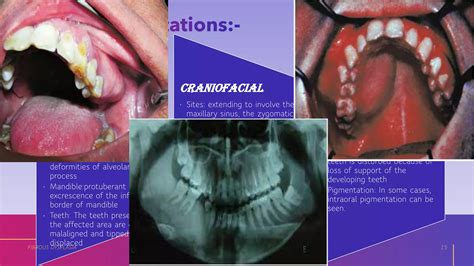Fibrous Dysplasia Bone Lesion Of The Jaw Pptx