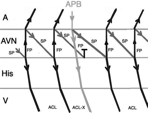 Response To An Early Apb In Avnrt With Simultaneous Anterograde Fast