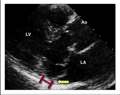 Figure 1 From Mitral Annular Disjunction The Forgotten Component Of Myxomatous Mitral Valve