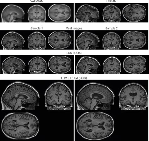 Figure 1 From Brain Imaging Generation With Latent Diffusion Models Semantic Scholar