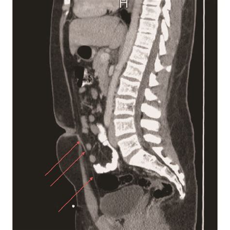 Pdf An Adult With A Remnant Urachus Anomaly Diagnosed In The