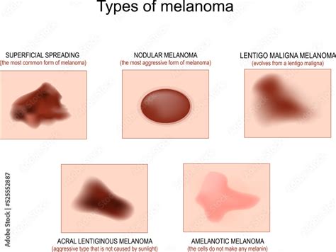 Types Of Melanoma Stock Vector Adobe Stock