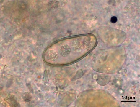 Surprises On Microscopic Fecal Examination