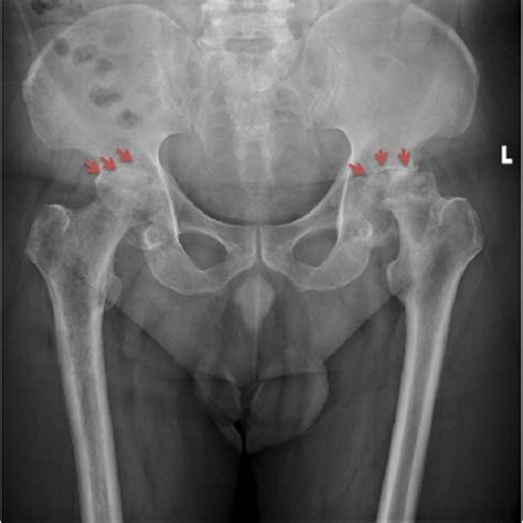 Patient 5 A 52 Year Old Male Anteroposterior Radiograph Of The Hip