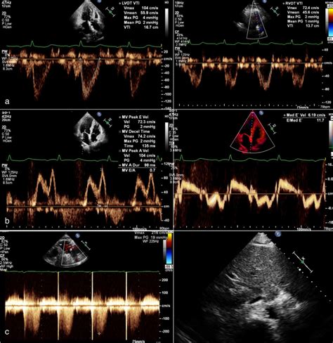 Improvement In Cardiac Function After Removal Of Impella With A Cardiac