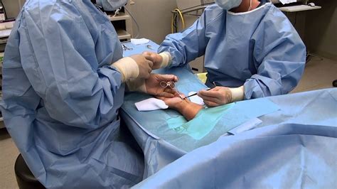 Endoscopic Carpal Tunnel Surgery Youtube