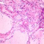 Difference Between Tag Archive For Hemangioma Hemangioma