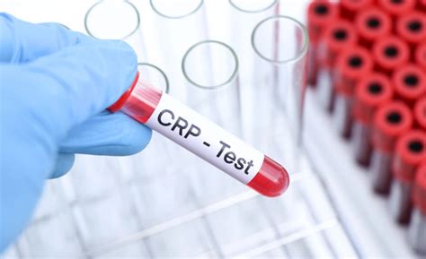 Crp Test Čo Znamená Ako Prebieha A Aké Sú Hodnoty Tvojezdravie Sk