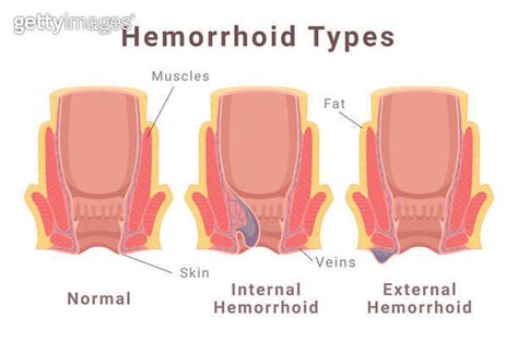 Hemorrhoid Types Scheme With Normal Internal And External Poster