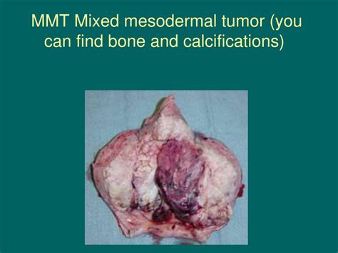 Ppt Malignant Diseases Of The Uterus Powerpoint Presentation Free