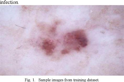 Figure 1 From Skin Cancer Detection Using Deep Learning Semantic Scholar
