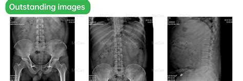 중국 흉부 X 레이 기계 제조 업체 공장 저렴한 가격의 흉부 X 레이 기계