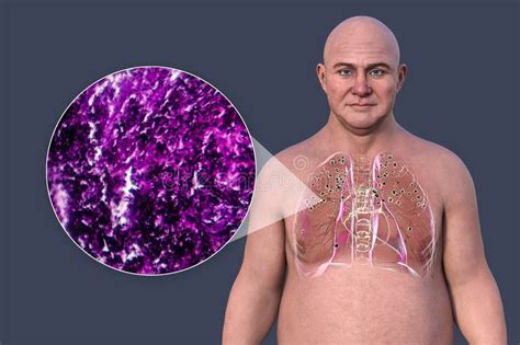 Man With Silicosis 3d Illustration And Light Micrograph Stock Illustration Illustration Of