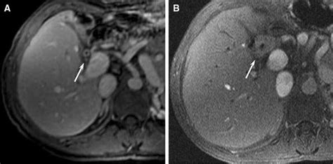 Periductal Infiltrating Cholangiocarcinoma In A 31 Year Old Man With Download Scientific