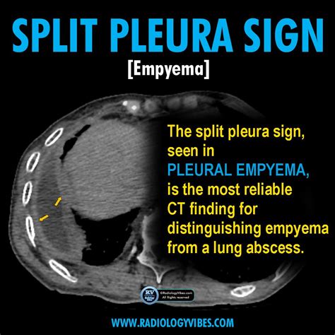 Radiology Vibes The Split Pleura Facebook