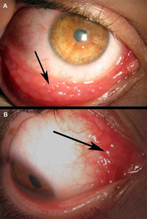 Bacterial Conjunctivitis Causes Symptoms Diagnosis Treatment