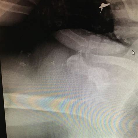 B Posterior Shoulder Dislocation Transcapular Y View The Transcapular Download Scientific