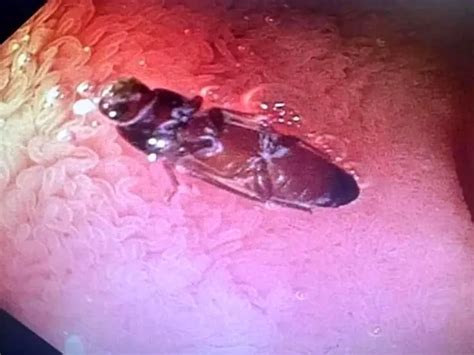 وجود سوسک زنده در روده مرد هندی دردسرساز شدعکس