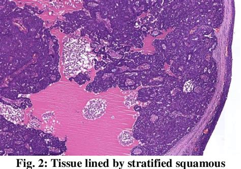 Apocrine Adenocarcinoma Arising In The Gland Of Moll A Brief Clinico