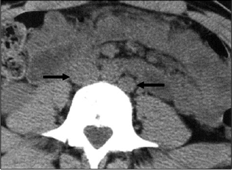 Inferior Vena Cava Ivc Duplication Unenhanced Computed Tomography