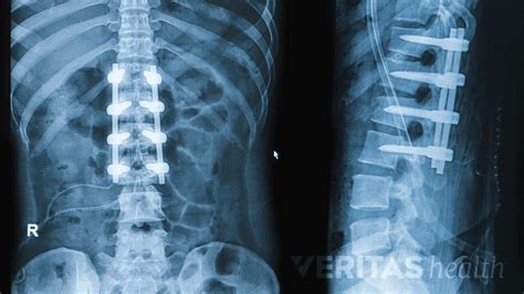 Scoliosis Surgery