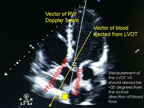 Whats Your Doppler Angle Criticalcarenow