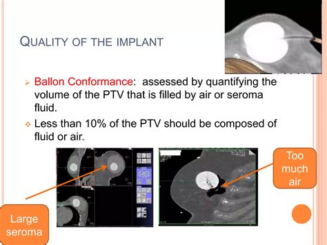 Accelerated Partial Breast Irradiation Pptx Cancer Diseases And Conditions