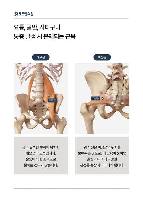 허리 골반 사타구니가 계속 아플 때 산부인과에서 하는 치료를 소개합니다 로즈앤 의학 칼럼
