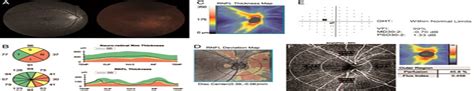 Glaucoma Detection In Myopic Eyes Structural And Vascular A
