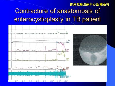 Enterocystoplasty And Urinary Diversion Ppt Download