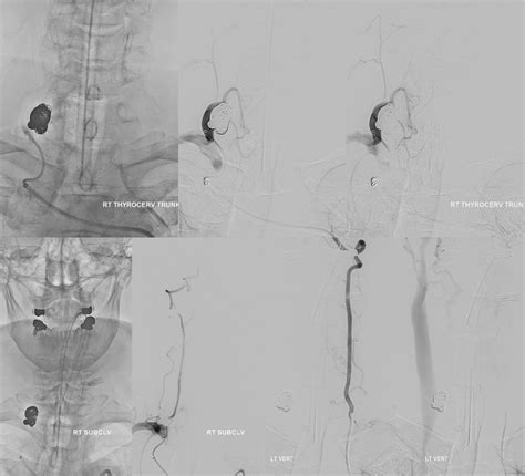 The One Off Club — Thyrocervical Trunk Fistula