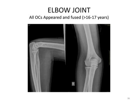 Age Estimation By Radiological Method Using X Rays Pptx