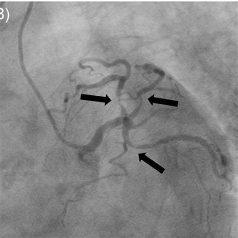 Coronary Artery Angiographic Images Showing Multivessel Disease With A Download Scientific